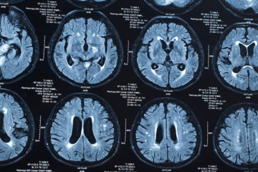 Traumatisch hersenletsel - Fysiotherapie Leeuwarden First Fysio