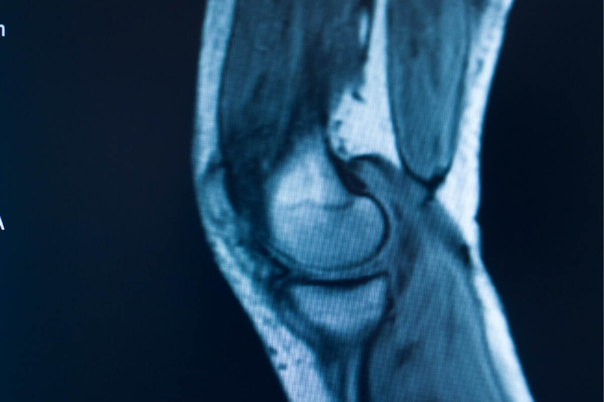 Degeneratief meniscus letsel - Fysiotherapie Leeuwarden First Fysio
