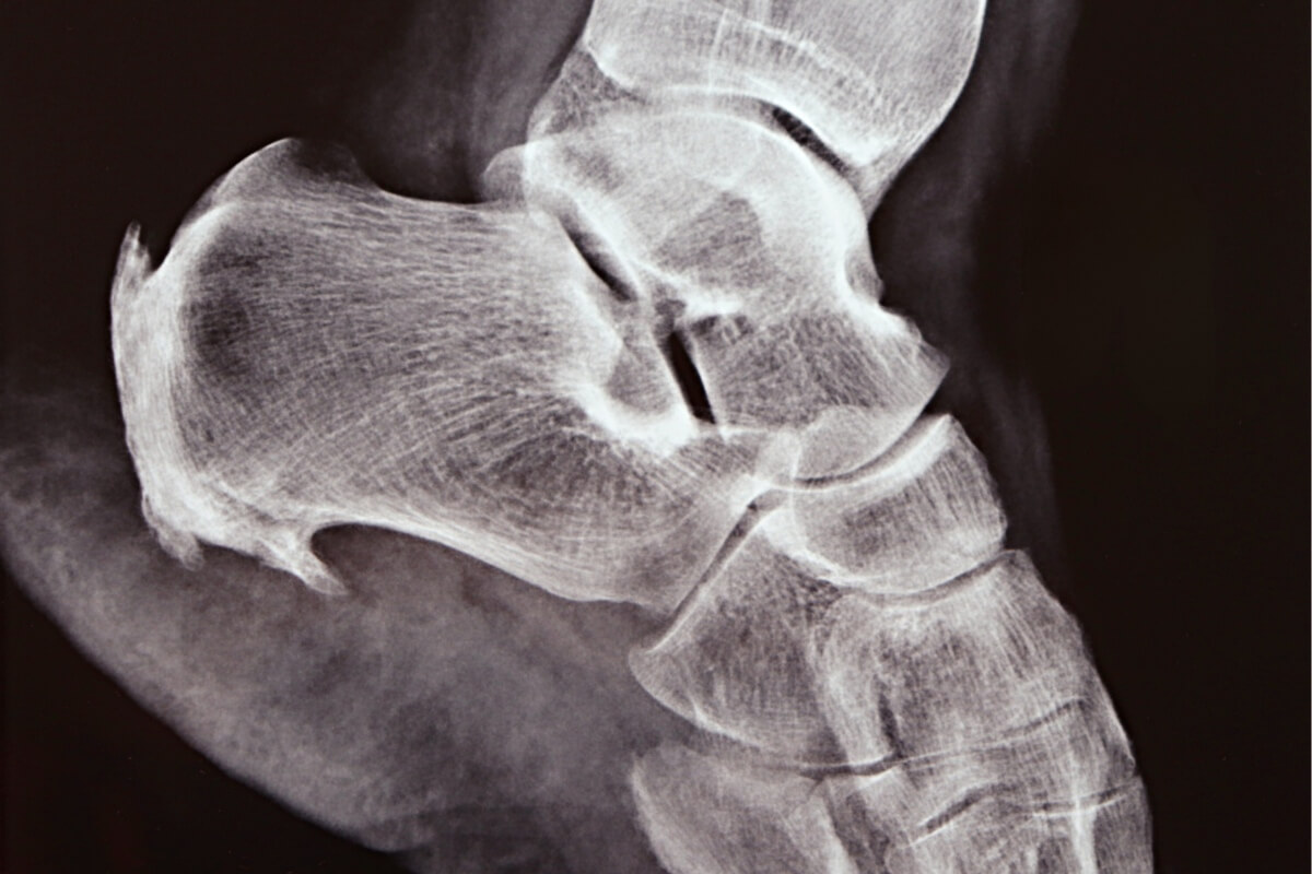 Haglundse exostose | Fysio Leeuwarden First Fysio